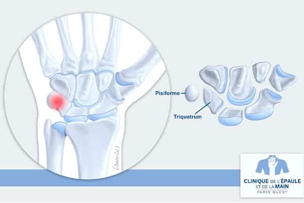 L’arthrose Piso-Triquétrale - Chirurgie du poignet Paris Ouest & 92